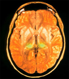 Creutzfeldt–Jakob disease - Top 10 Worst and Dangerous Incurable ...