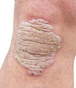 Understanding Psoriasis : Types of Psoriasis.