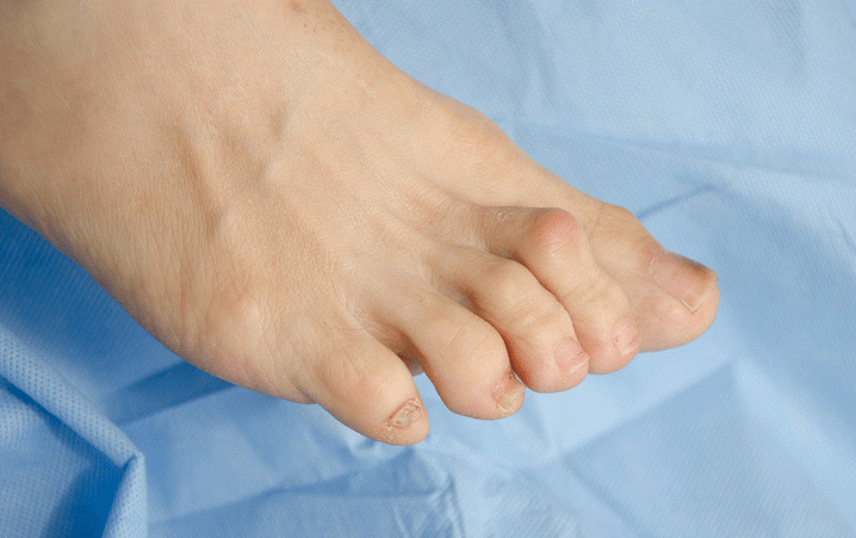 Claw Toes: Deformity of the foot - Women Fitness