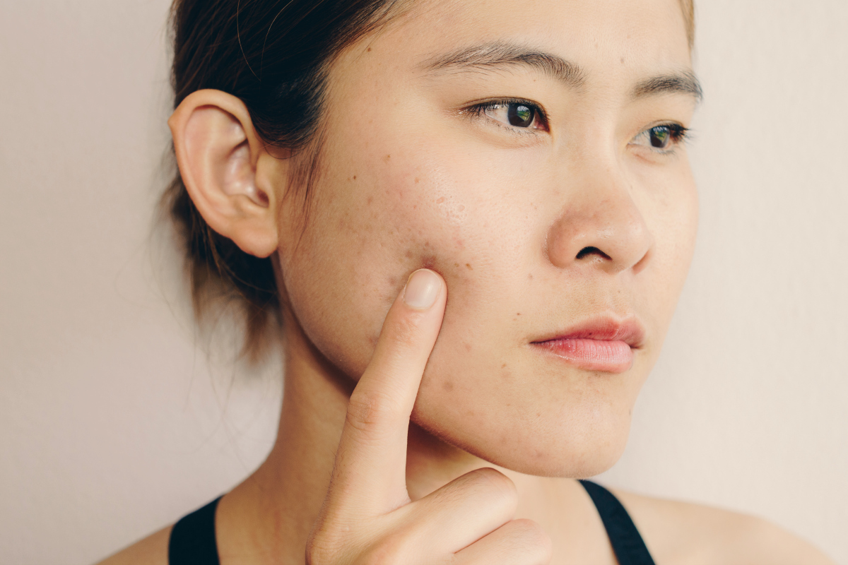 Acne Scars: Types & Most Effective Treatment Options - Women Fitness