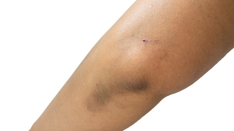 Insulin Resistance & How It Affects Skin - Women Fitness